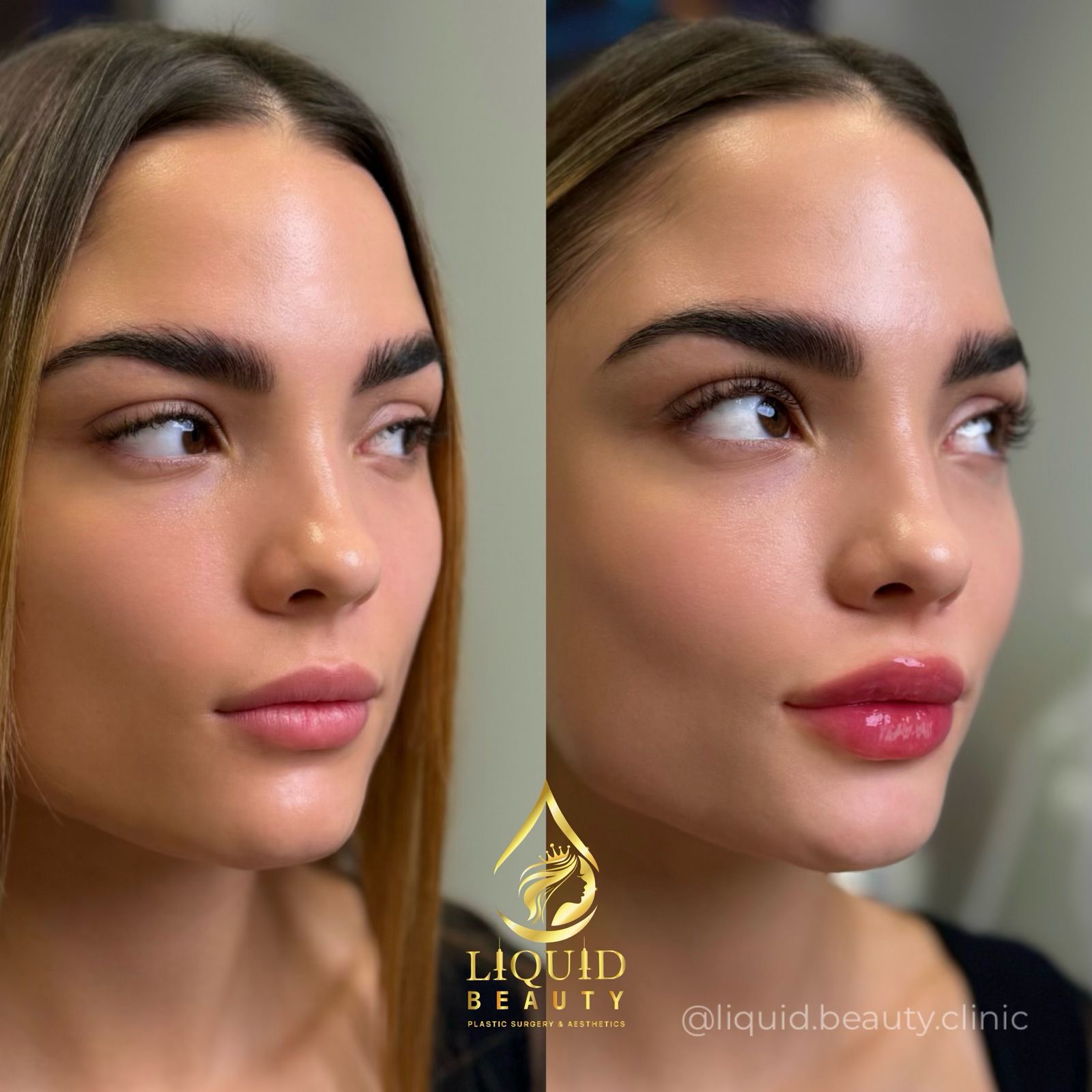 Fillers – Liquid Beauty Clinic